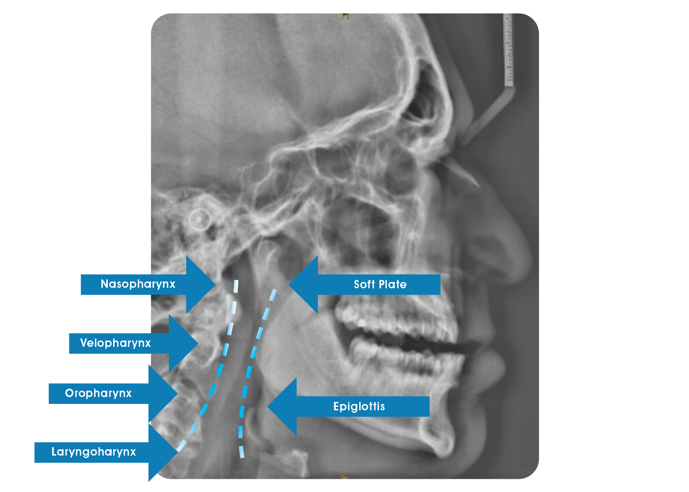 RIPsnore 2 x Anti Snoring Mandibular Advancement Splint Device